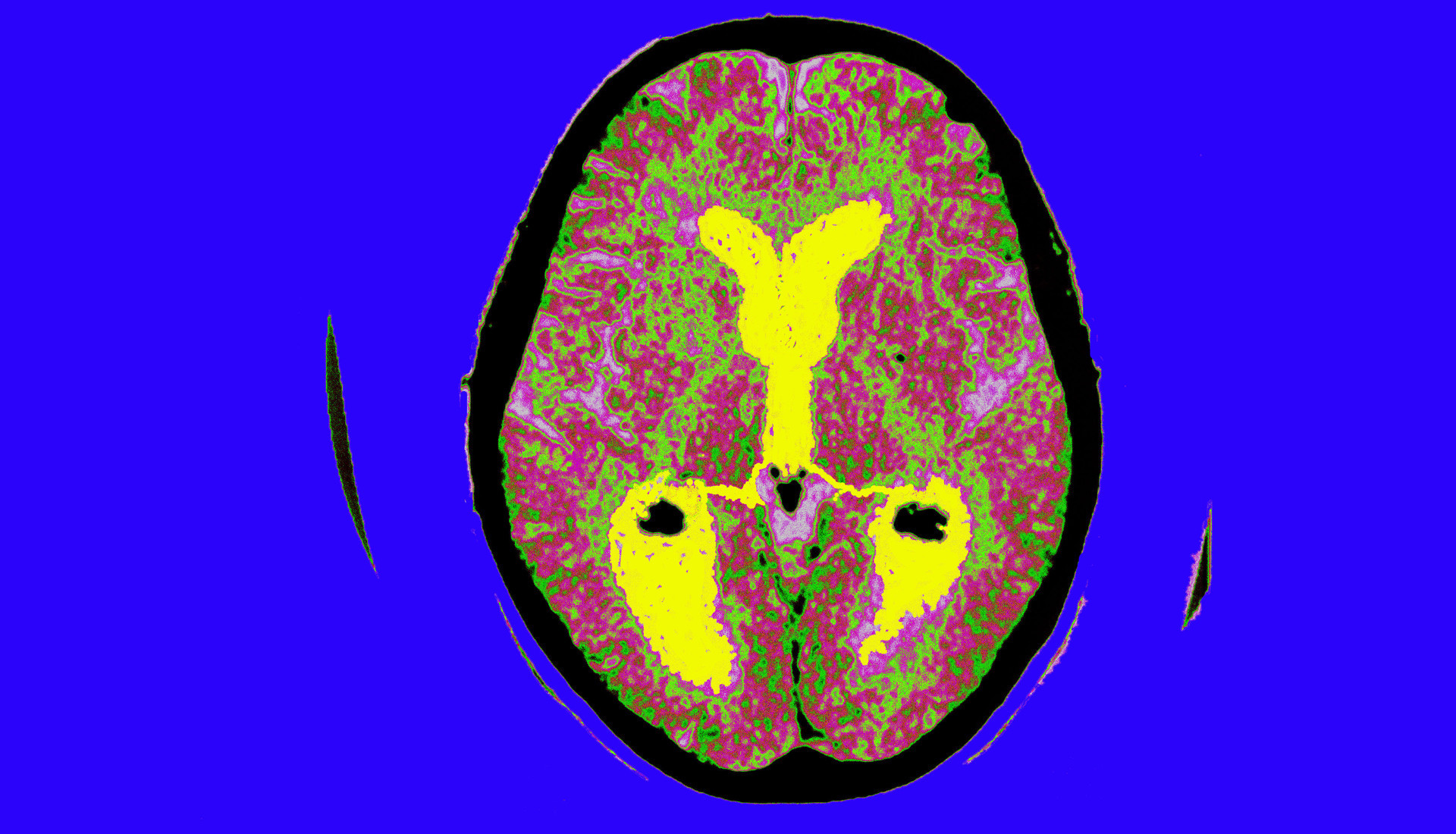 Dementie, hoe werkt dat in je hoofd? - De Correspondent